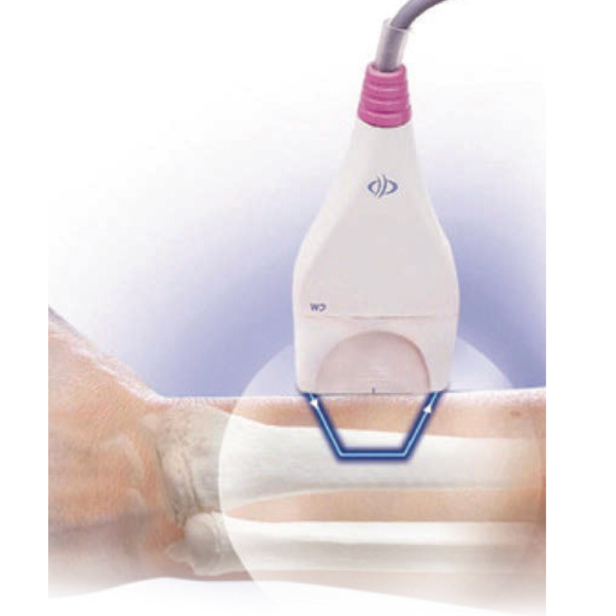 Sunlight MiniOmni Bone Densitometer - Ultrasound-based Osteoporosis Sc